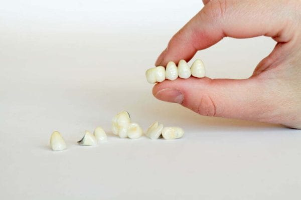 PFM (Porcelain crown/bridges fused to metal) – Laboratoire Dentaire RB